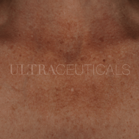 Ultra Retexturising Body Complex Online – Ultraceuticals US